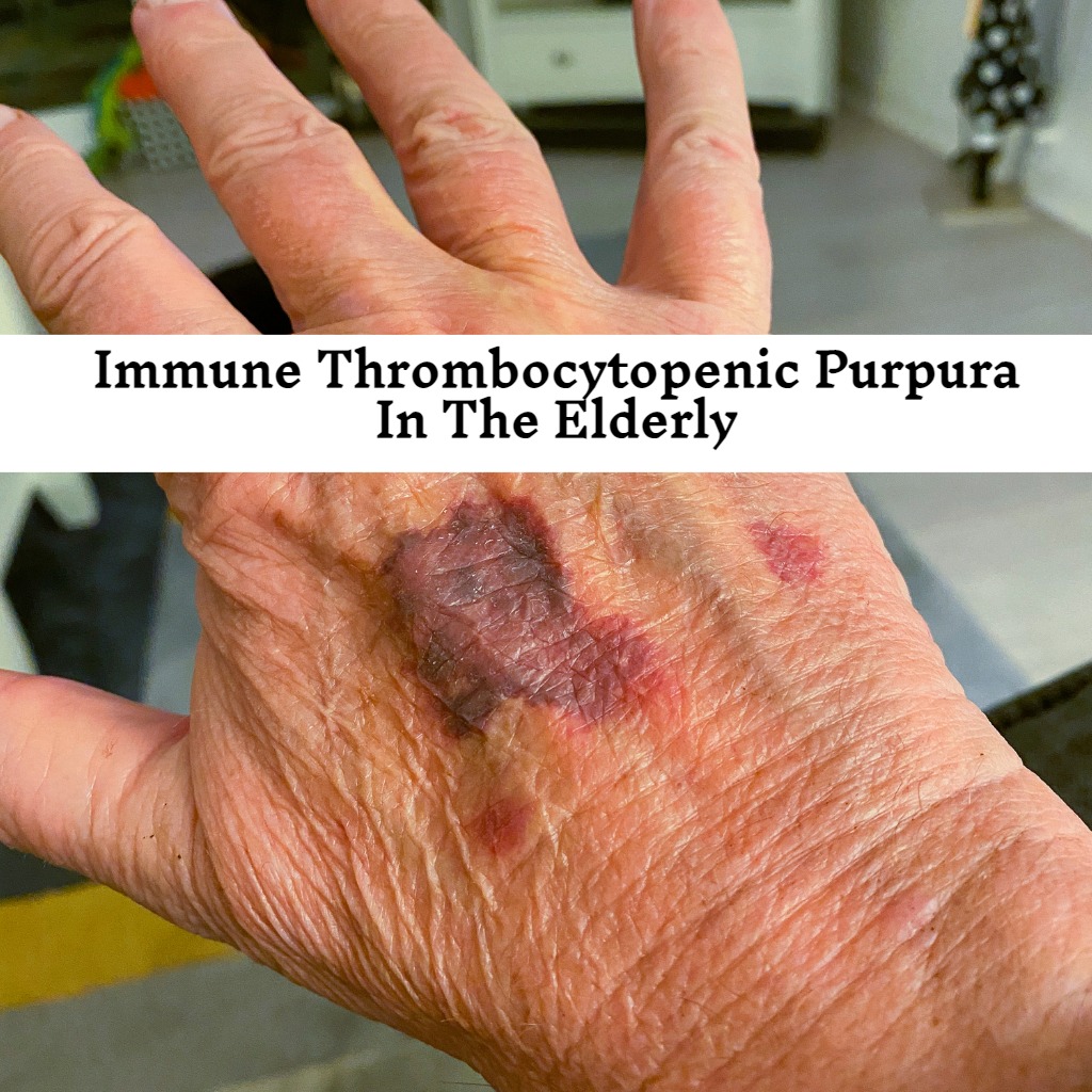 Immune Thrombocytopenic Purpura in The Elderly - EZ.Insure